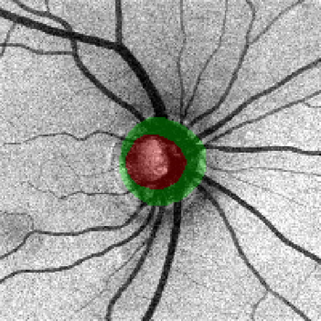 Ophthalmic Image Analysis | Iowa Institute for Biomedical Imaging - The ...