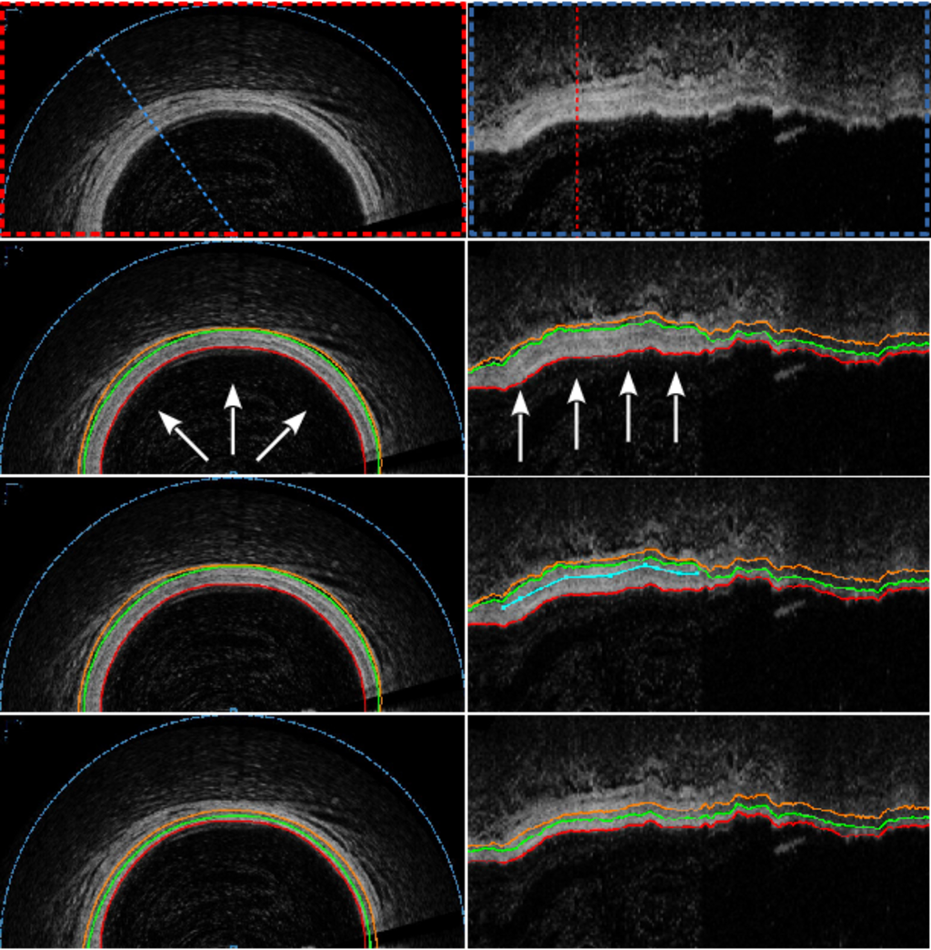 Cardiovascular Image Analysis | Iowa Institute for Biomedical Imaging - Carver College of ...