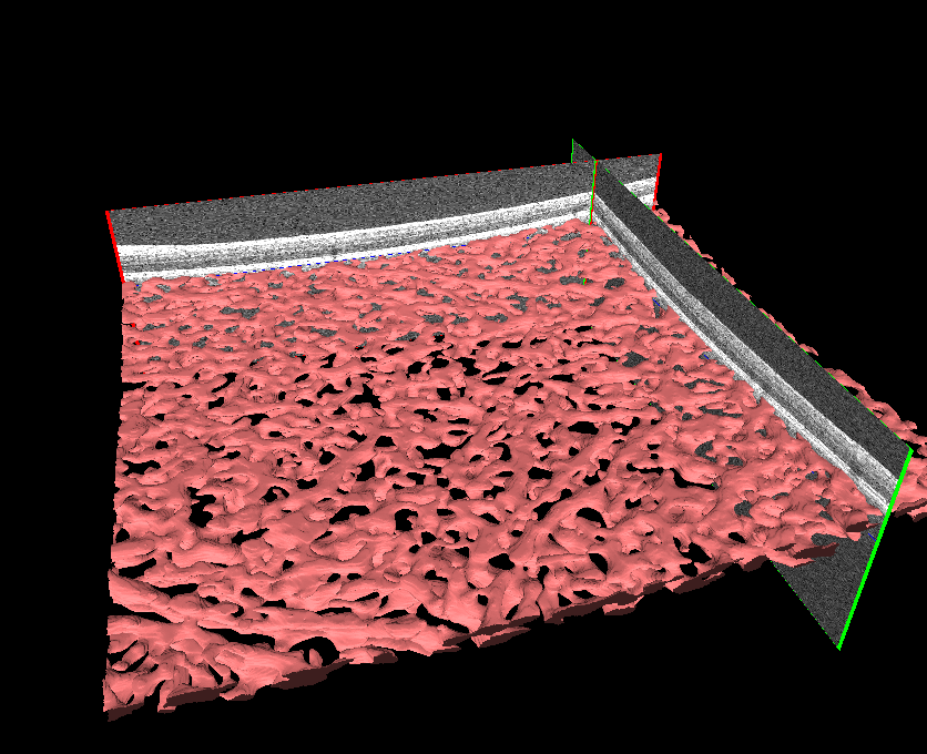 Ophthalmic Image Analysis | Iowa Institute for Biomedical Imaging - The ...