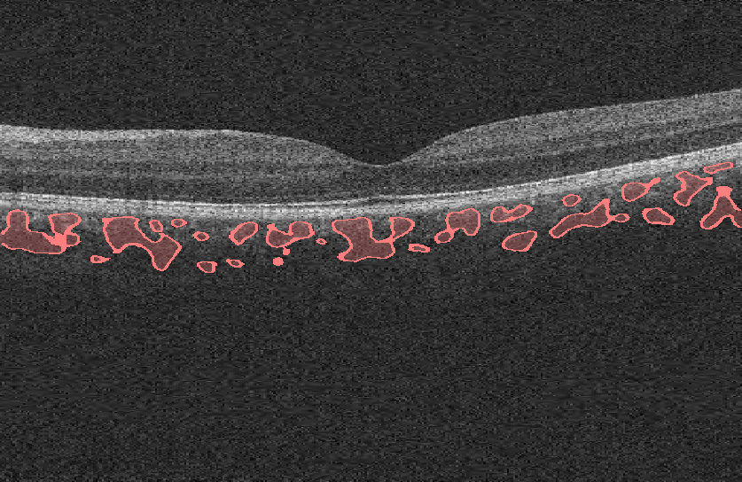 Ophthalmic Image Analysis | Iowa Institute for Biomedical Imaging - The ...