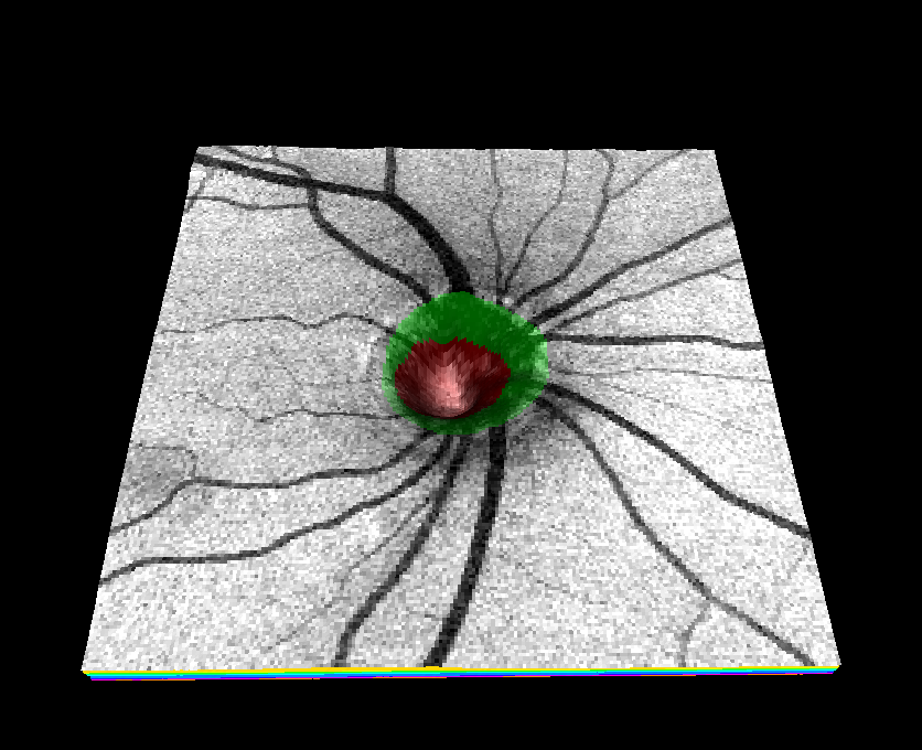 Ophthalmic Image Analysis | Iowa Institute for Biomedical Imaging - The ...