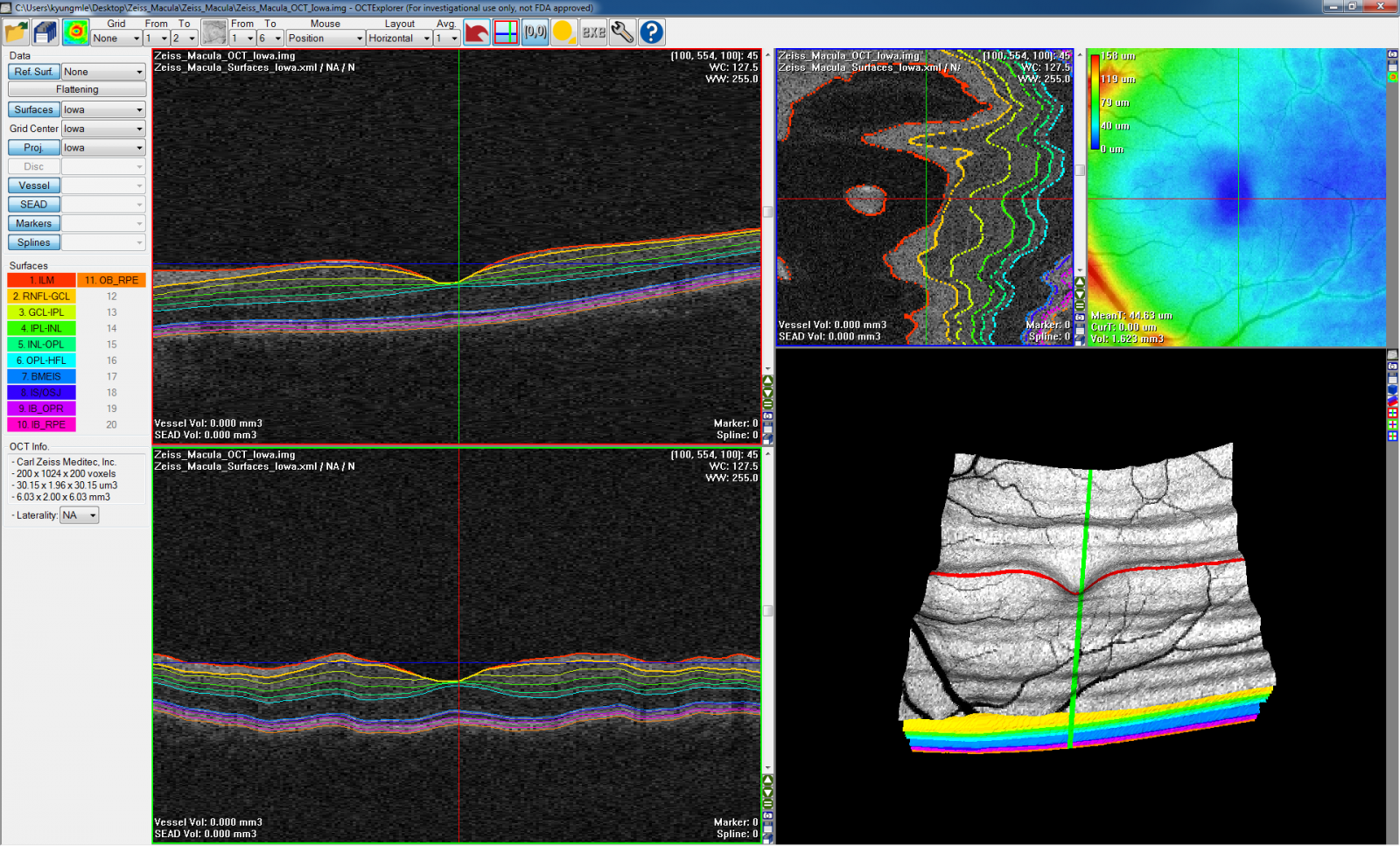 Ophthalmic Image Analysis | Iowa Institute for Biomedical Imaging - The ...