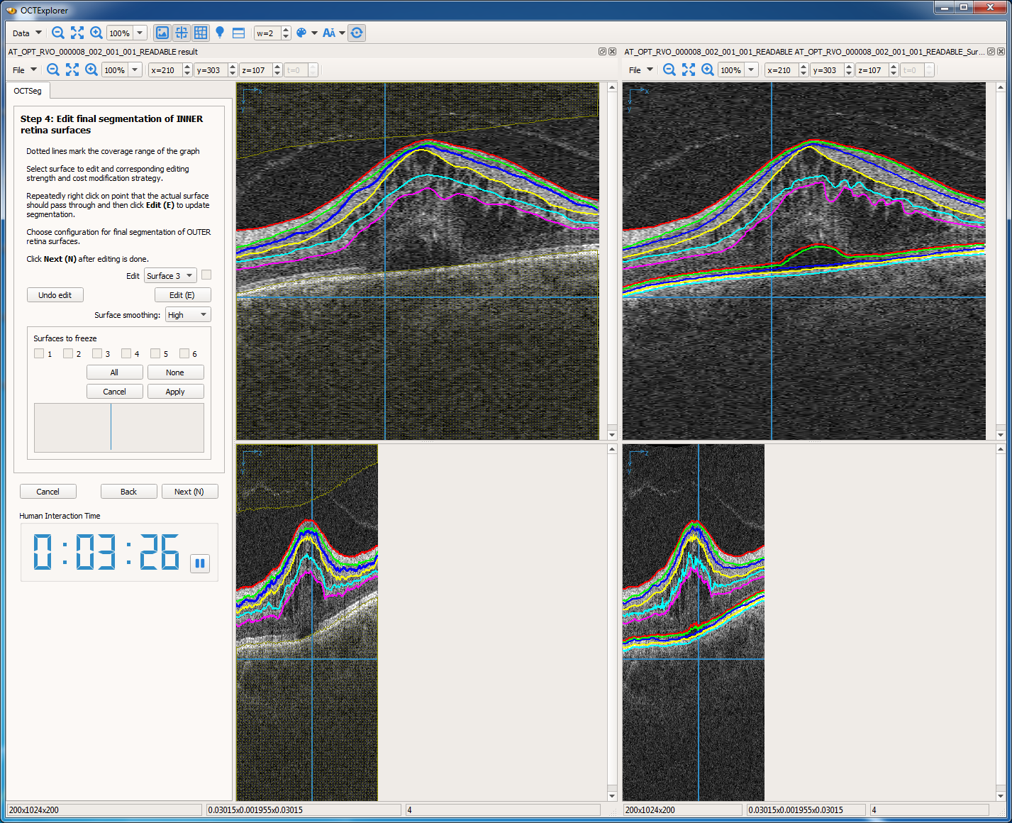 Ophthalmic Image Analysis | Iowa Institute for Biomedical Imaging - The ...