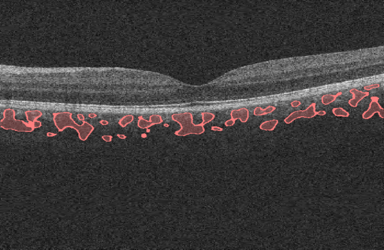 Ophthalmic Image Analysis | Iowa Institute for Biomedical Imaging - The ...