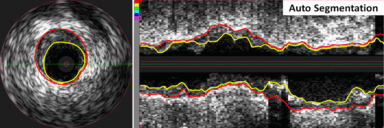 Cardiovascular Image Analysis | Iowa Institute for Biomedical Imaging ...