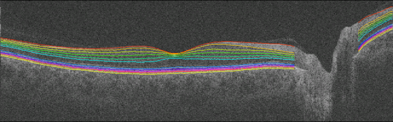 Ophthalmic Image Analysis | Iowa Institute for Biomedical Imaging - The ...